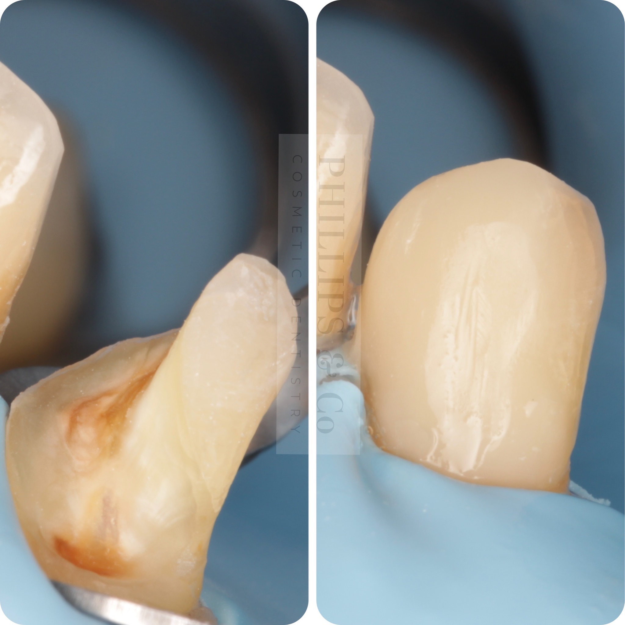 Composite Case 2 - Phillips & Co Cosmetic Dentistry | Dentist in ...