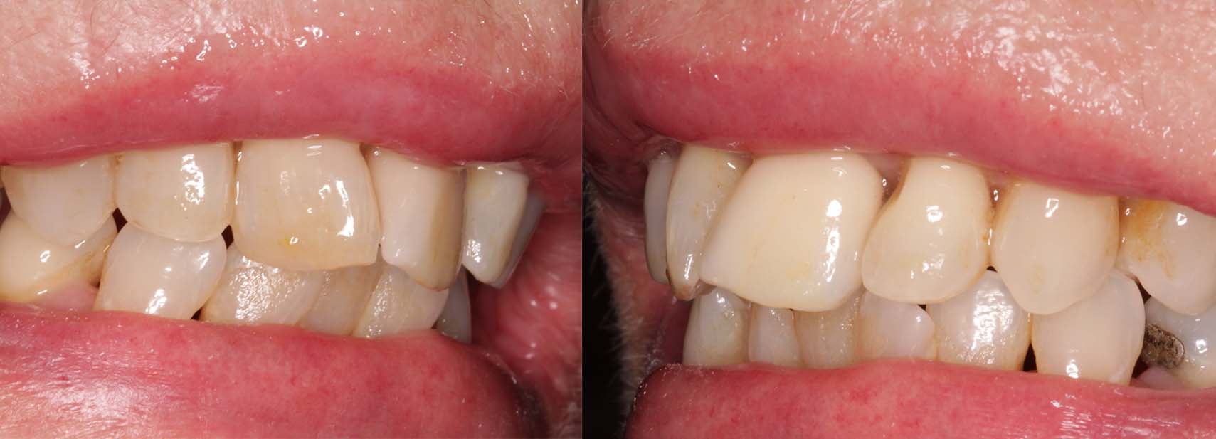Implant Case 1 - Phillips & Co Cosmetic Dentistry | Dentist in ...