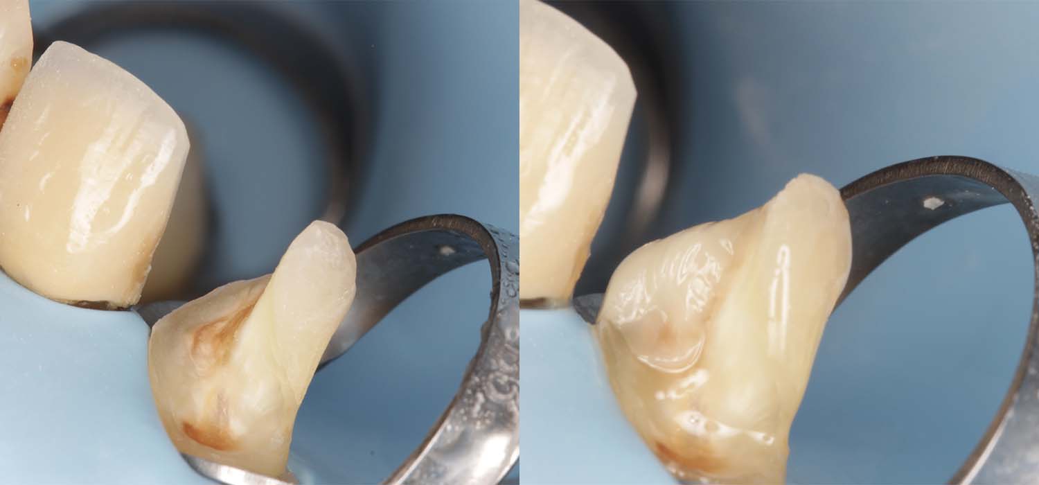 Composite Case 2 - Phillips & Co Cosmetic Dentistry | Dentist in ...